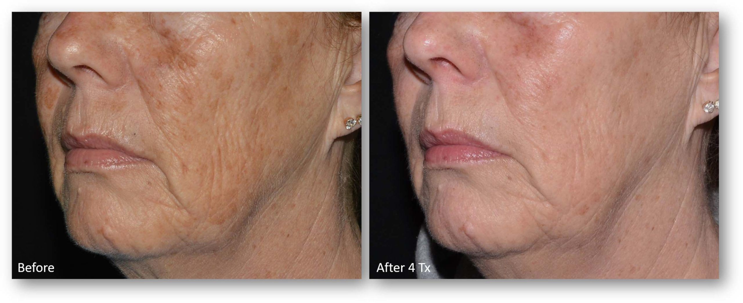 LaseMD Ultra - Finally A Treatment for Melasma - Modesto Aesthetics & Laser